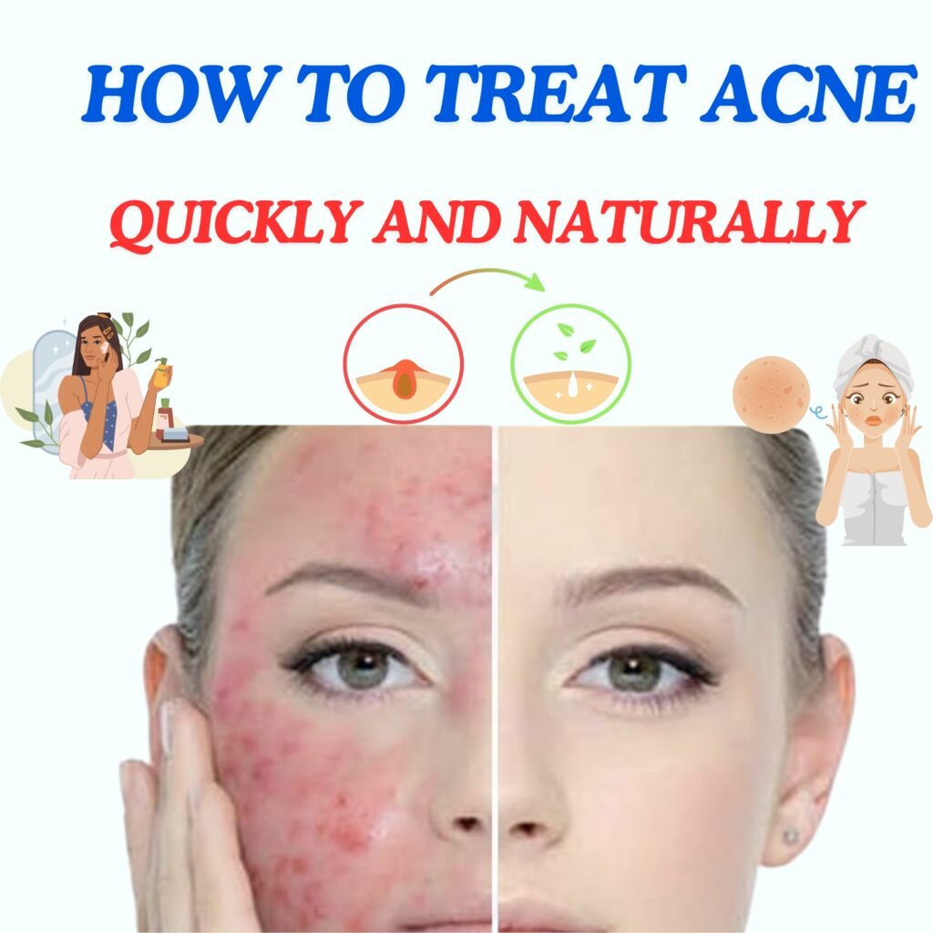 How to treat acne quickly and naturally - Medsparkles (SMC-Pvt) Limited