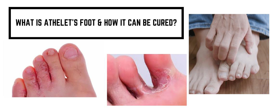 ATHLETE’S FOOT – CAUSES, SYMPTOMS AND TREATMENT - Medsparkles (SMC-Pvt ...
