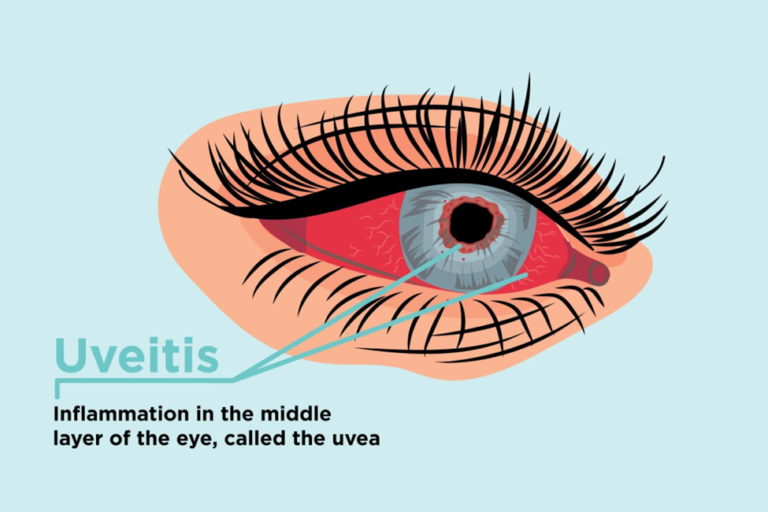 Understanding Uveitis: Causes, Symptoms, and What You Need to Know ...